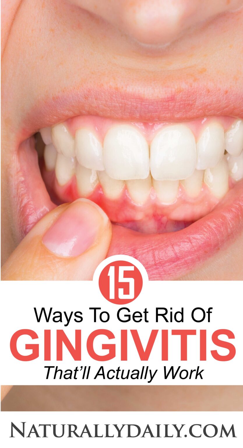 15 Natural Ways To Get Rid Of Gingivitis Thatll Actually Work