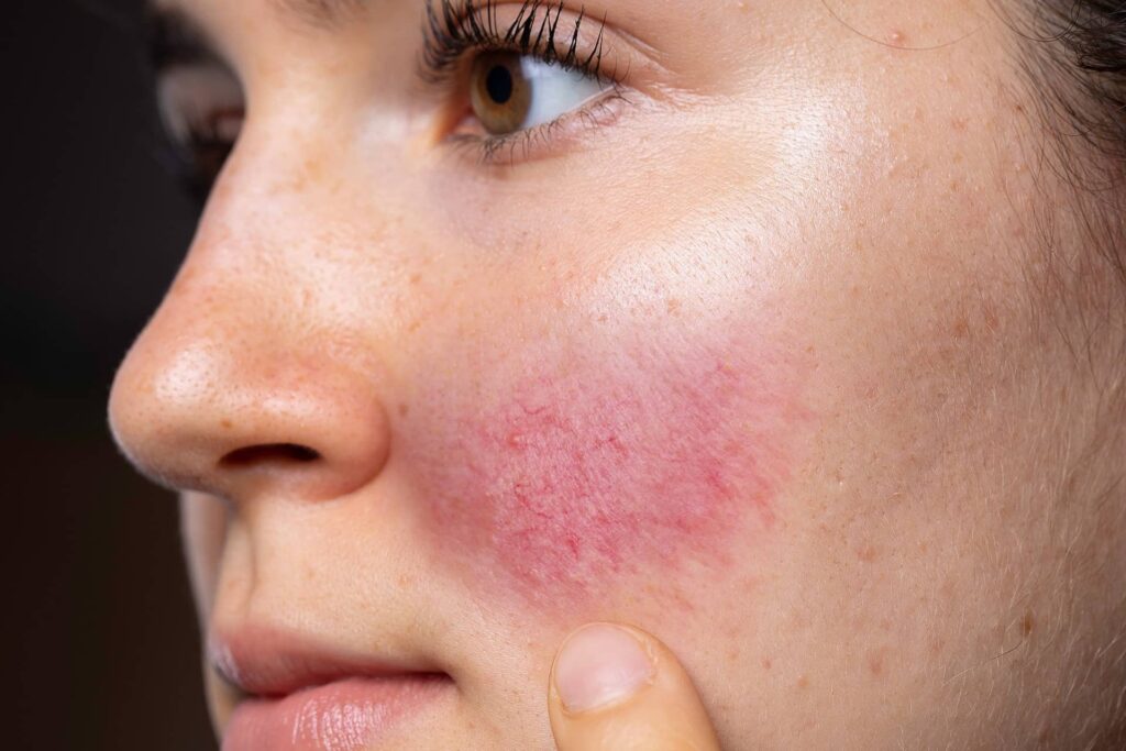 13 Essential Oils for Rosacea and How to Use Them - Naturally Daily