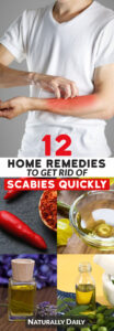 12 Home Remedies to Get Rid of Scabies Naturally - Naturally Daily