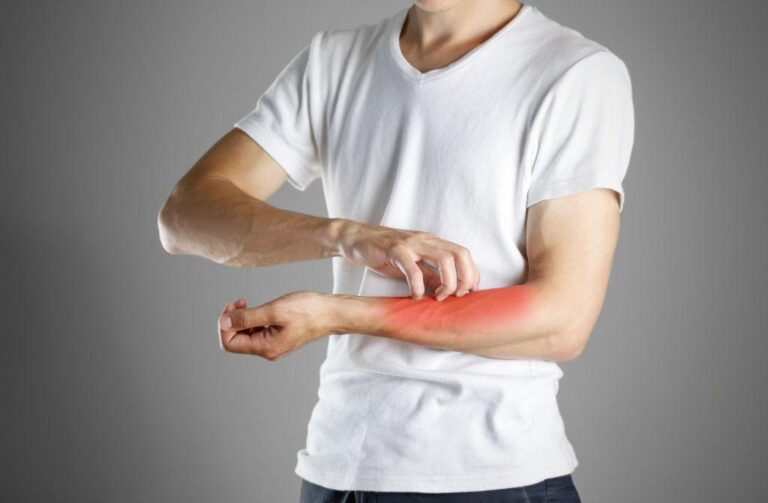 12 Home Remedies To Get Rid Of Scabies Naturally Naturally Daily