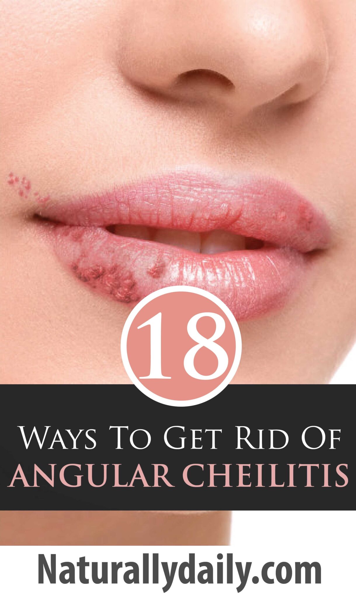 18 Quick Home Remedies for Angular Cheilitis - Naturally Daily