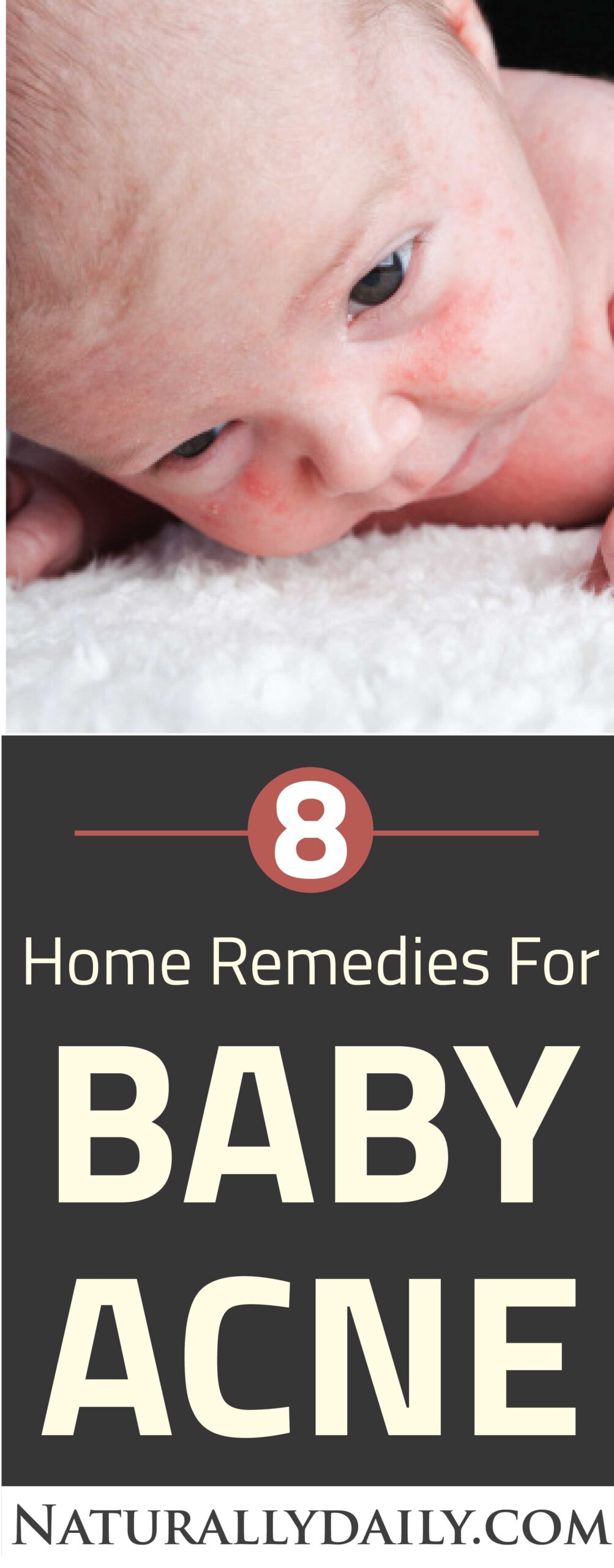 8 Safe Home Remedies for Baby Acne - Naturally Daily