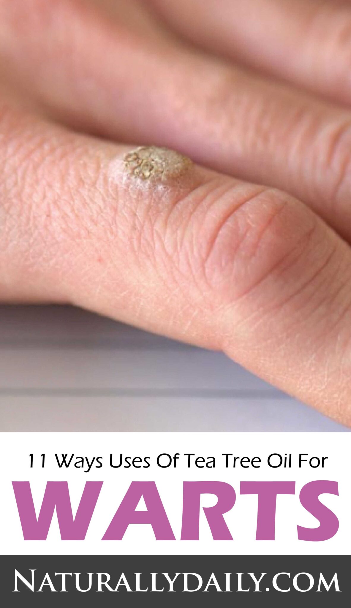 Tea Tree Oil for Warts: 11 Effective Ways to Use