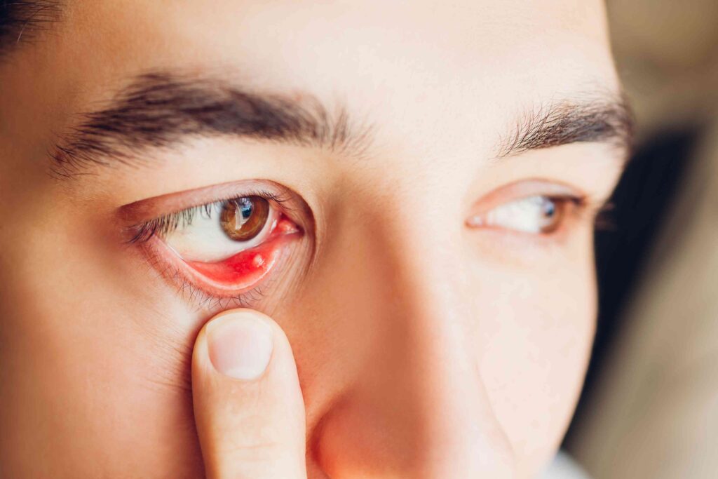 19 Home Remedies for Stye Relief - Naturally Daily