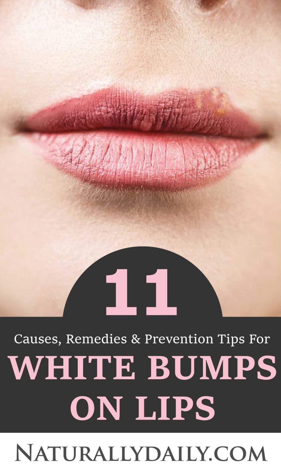White Bumps on Lips: Causes, Remedies, Prevention Tips - Naturally Daily